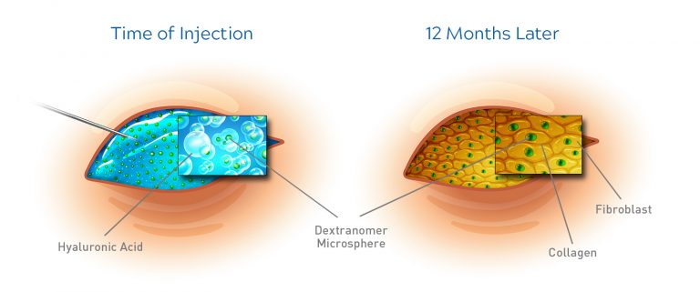 Deflux method of action - Deflux